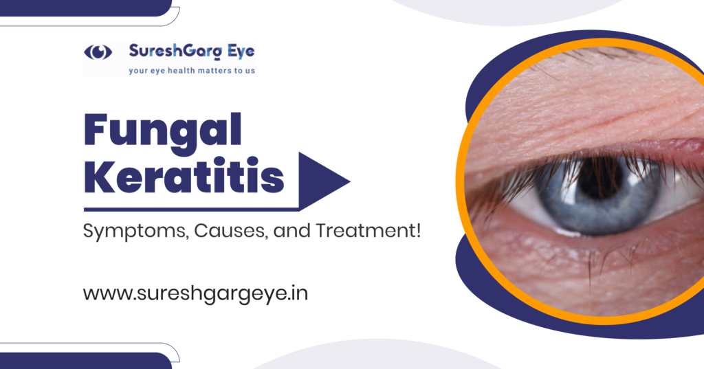 Unraveling Fungal Keratitis: Symptoms, Causes, and Effective Treatment