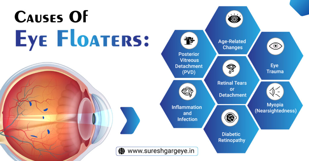 Effective Eye Floaters Treatment in Delhi NCR